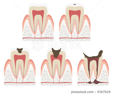 Dental Caries Progression When Plaque Combines With The Sugars And