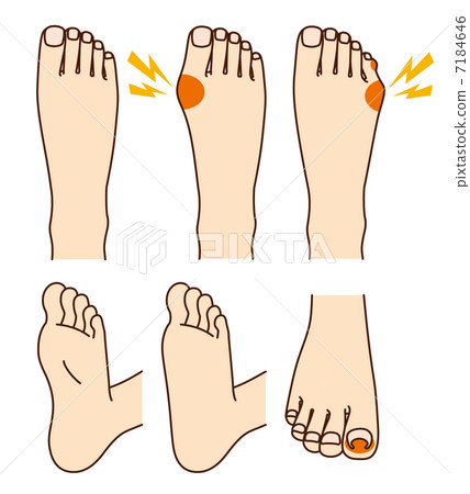 Foot trouble - Stock Illustration [7184646] - PIXTA