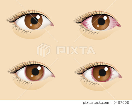 Congested eyes - Stock Illustration [9407608] - PIXTA