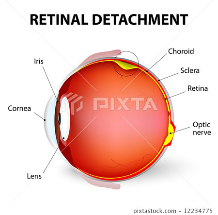 Retinal detachment. Vector diagram - Stock Illustration [12234775] - PIXTA