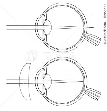 Cross sectional view of hyperopia - Stock Illustration [16953435] - PIXTA