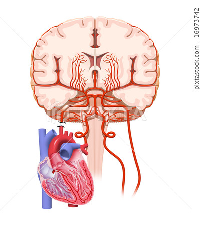 Cardiogenic cerebral embolism - Stock Illustration [16973742] - PIXTA