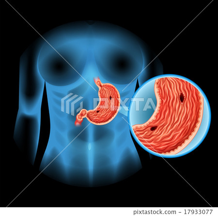 Stomach Ulcer diagram in human - Stock Illustration [17933077] - PIXTA