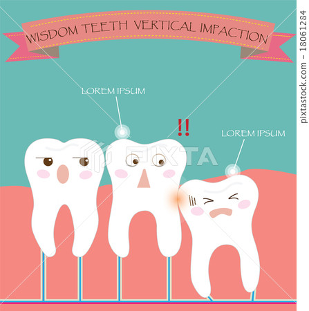 Wisdom Teeth Vertical Impaction - Stock Illustration [18061284] - PIXTA