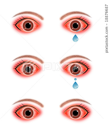 Congested eyes - Stock Illustration [18876687] - PIXTA