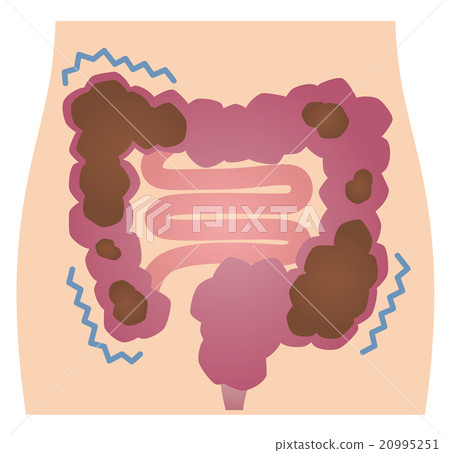 Constipation of colon health - Stock Illustration [20995251] - PIXTA