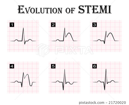 Evolution of STEMI-插圖素材 [21720020] - PIXTA圖庫