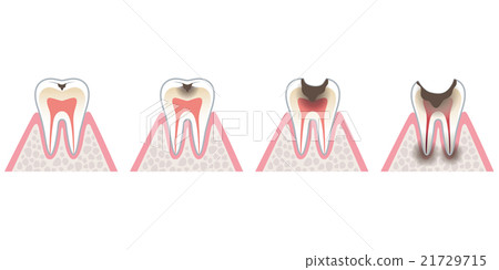 Caries progression - Stock Illustration [21729715] - PIXTA