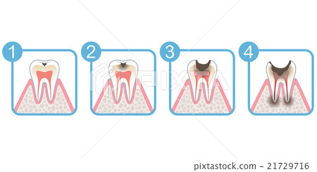 Caries progression - Stock Illustration [21729716] - PIXTA