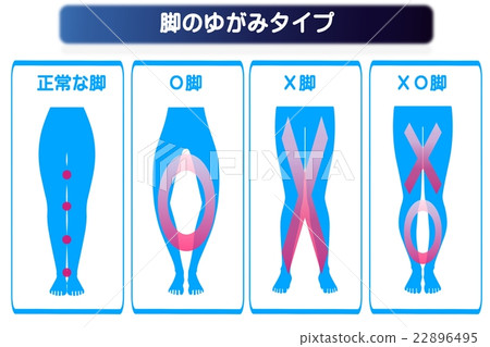 Classification and type of distortion of legs /... - Stock Illustration ...