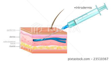 Diagram showing needle injection on skin - Stock Illustration [23510367 ...