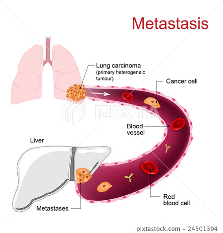 Metastasis. Metastases-插圖素材 [24501394] - PIXTA圖庫