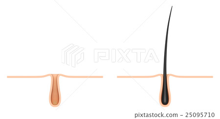 Hair root section - Stock Illustration [25095710] - PIXTA