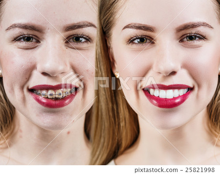 Perfect Teeth After Braces Side View