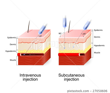 Intravenous therapy and Subcutaneous injection. - Stock Illustration ...