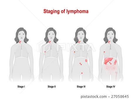 Staging of lymphoma - Stock Illustration [27058645] - PIXTA