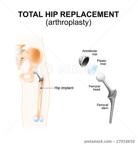 Total hip replacement or arthroplasty. - Stock Illustration [27058650 ...