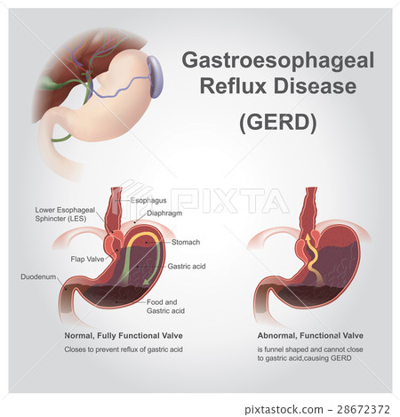 gastro reflux - Stock Illustration [28672372] - PIXTA