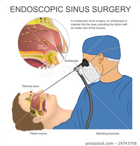 Endoscopic sinus surgery. Vector graphic. - Stock Illustration ...