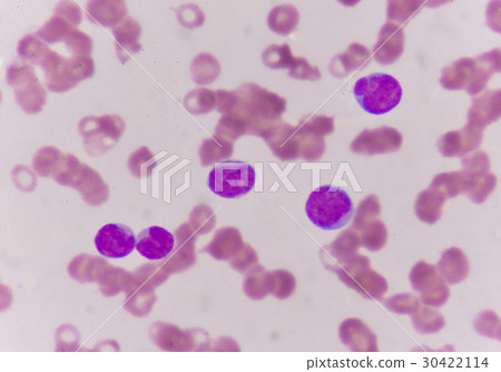 Burst Red Blood Cells Smear
