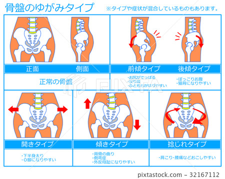 Pelvic distortion / classification Figure 1... - Stock Illustration ...