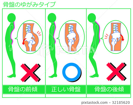 Comparison of distortion of the pelvis... - Stock Illustration ...