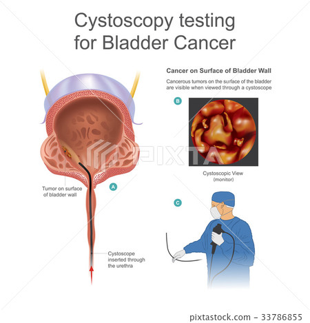 Cystoscopy testing for Bladder Cancer-插圖素材 [33786855] - PIXTA圖庫