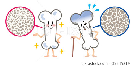 Bone bone density osteoporosis illustration - Stock Illustration ...