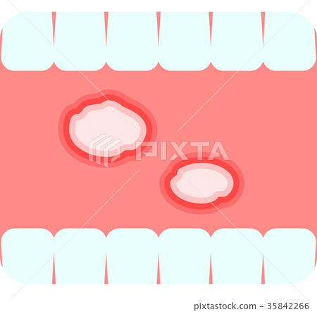 stomatitis - Stock Illustration [35842266] - PIXTA