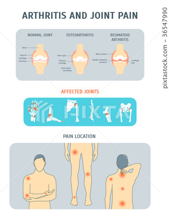 Cartoon Arthritis and Joint Pain Set. Vector - Stock Illustration ...