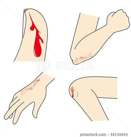 Scratches and cuts of hands and feet - Stock Illustration [38150842 ...