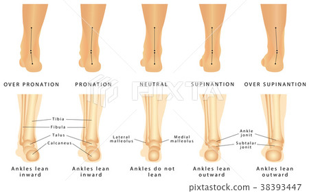 Foot deformation - Stock Illustration [38393447] - PIXTA