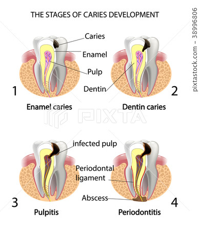 THE STAGES OF CARIES DEVELOPMENT-插圖素材 [38996806] - PIXTA圖庫