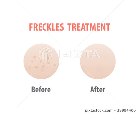 Freckles treatment comparison illustration vector-插圖素材 [39994400] - PIXTA圖庫