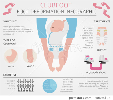 Foot deformation, medical infographic. Clubfoot - Stock Illustration ...