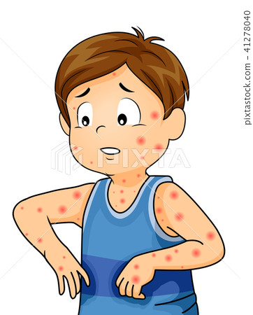 Kid Boy Chickenpox Illustration - Stock Illustration [41278040] - PIXTA