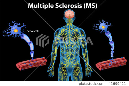 Human Anatomy of Multiple Sclerosis - Stock Illustration [41699421] - PIXTA