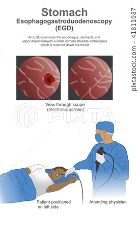 Esophagogastroduodenoscopy EGD - Stock Illustration [41811987] - PIXTA