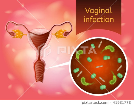 Vaginal Infection Realistic Vector Concept - Stock Illustration ...
