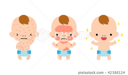 Baby with weak skin - Stock Illustration [42388124] - PIXTA