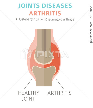 Joints diseases. Arthritis symptoms infographic - Stock Illustration ...