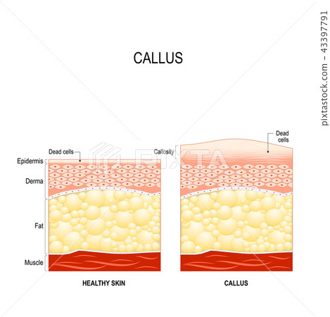 Callus. callosity - Stock Illustration [43397791] - PIXTA