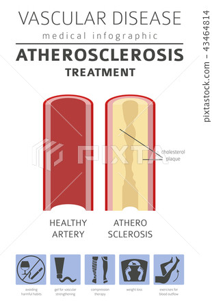 Vascular diseases. Atherosclerosis infographic-插圖素材 [43464814] - PIXTA圖庫