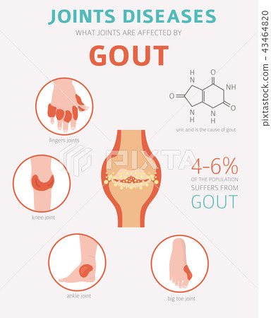Joints diseases. Gout infographic - Stock Illustration [43464820] - PIXTA