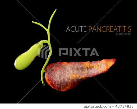 Acute pancreatitis 3d illustration,... - Stock Illustration [43734935 ...