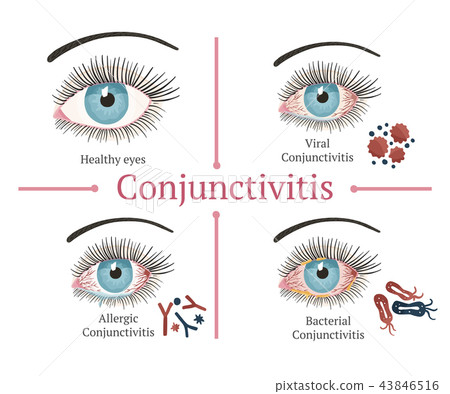Eye disease. Ophthalmology health illustration. - Stock Illustration ...