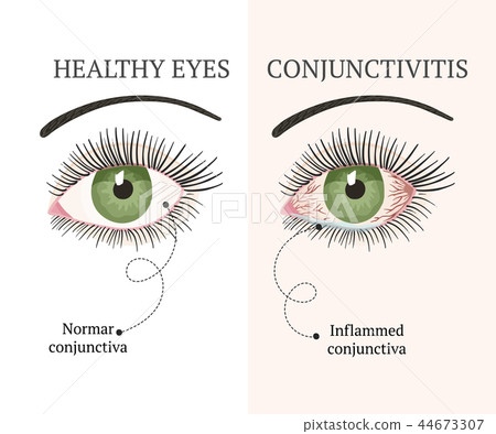 Eye disease. Ophthalmology health illustration. - Stock Illustration ...