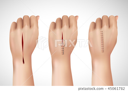 Surgical Stitching Hands Composition - Stock Illustration [45061782 ...