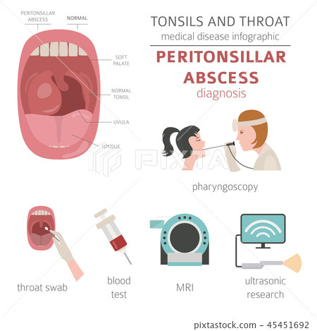 Tonsils and throat diseases. Peritonsillar abscess - Stock Illustration ...