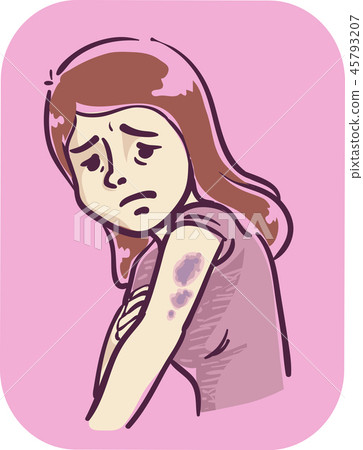 Girl Symptom Contusion Bruise Illustration - Stock Illustration ...